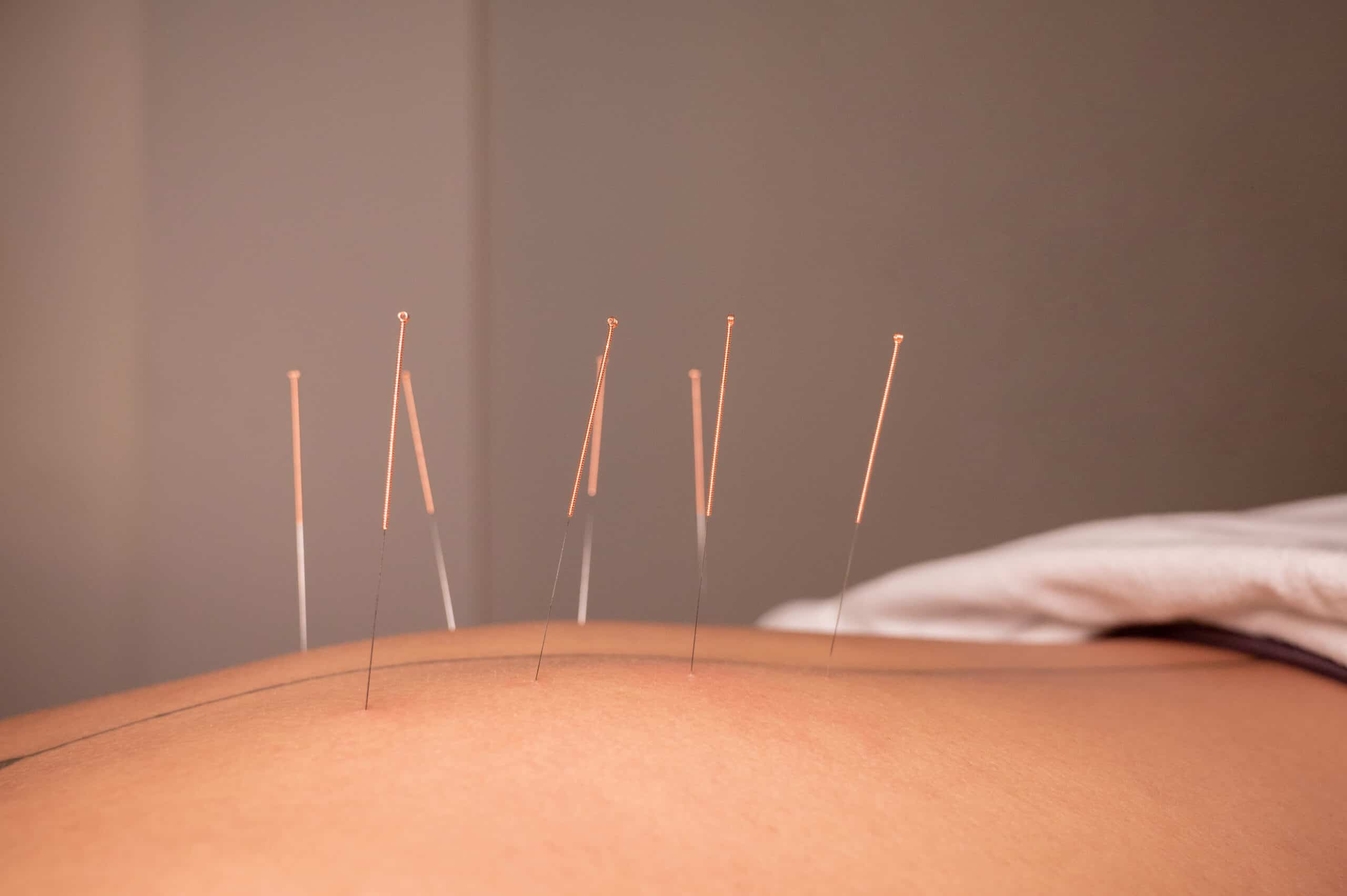 Traditional Chinese Acupuncture in Vancouver - Mount Pleasant, East Vancouver, West Broadway, Cambie